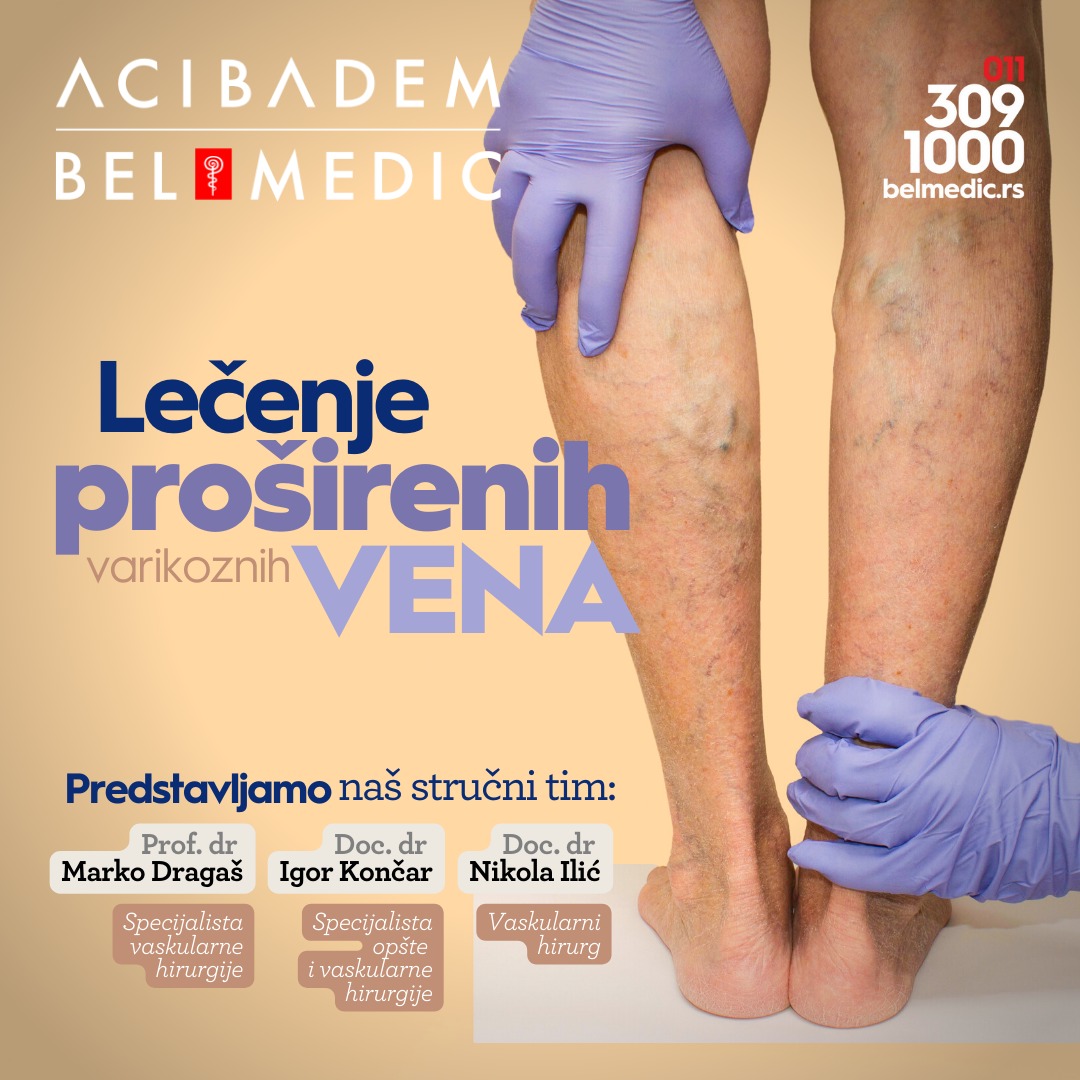Proširene (varikozne) vene nisu samo estetski problem | Acibadem Bel Medic